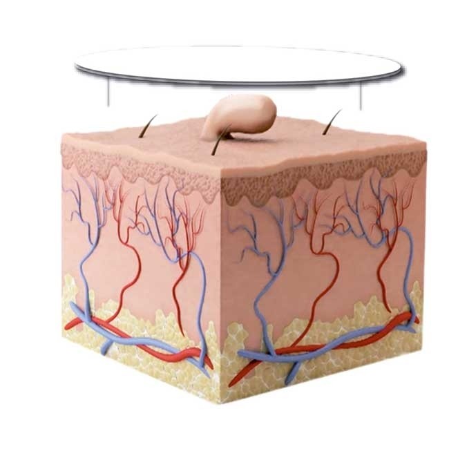 Formuclear Skin Tag Patch - Skin tag removal